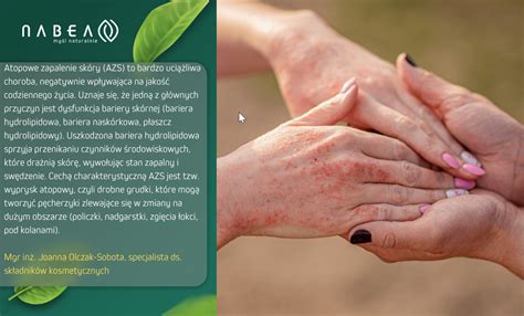 Atopowe zapalenie skóry objawy które zmniejszysz naturalnymi