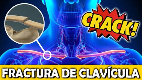FRACTURA DE CLAVÍCULA Ejercicios de rehabilitación YouTube