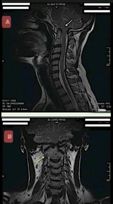 𝐃𝐫 𝐎𝐌𝐈𝐃 𝐁𝐀𝐍𝐃𝐀𝐑𝐂𝐇𝐈 𝐌 𝐃 on Twitter Basilar impression Patient neck