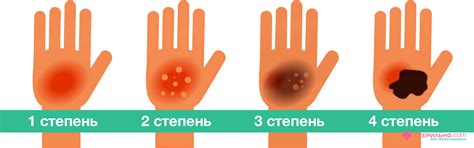 Степени Ожогов И Их Характеристика Фото Фото