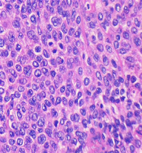 Histopathology Slide Of Diffuse Large B Cell Lymphoma Showing Diffuse