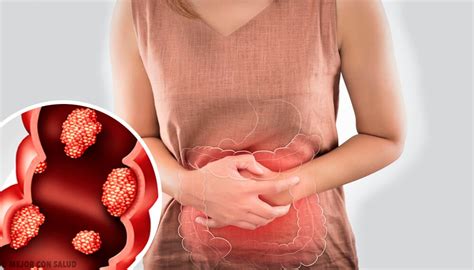 Síntomas de cáncer de colon