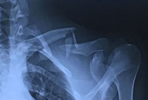 Tratamiento de fractura de clavícula cuándo es necesaria la cirugía