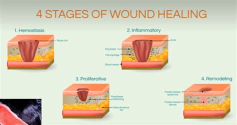 Wound Care Flashcards Quizlet