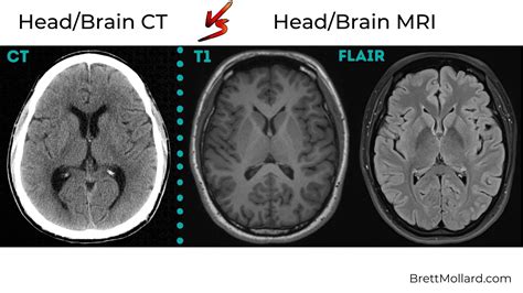CT Scan Vs MRI What S The Difference