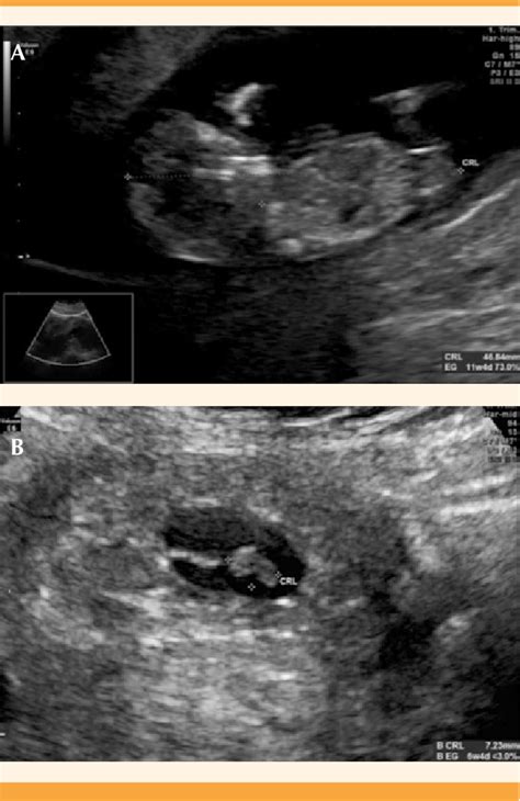A Ecografía pélvica transvaginal en corte longitudinal con embarazo