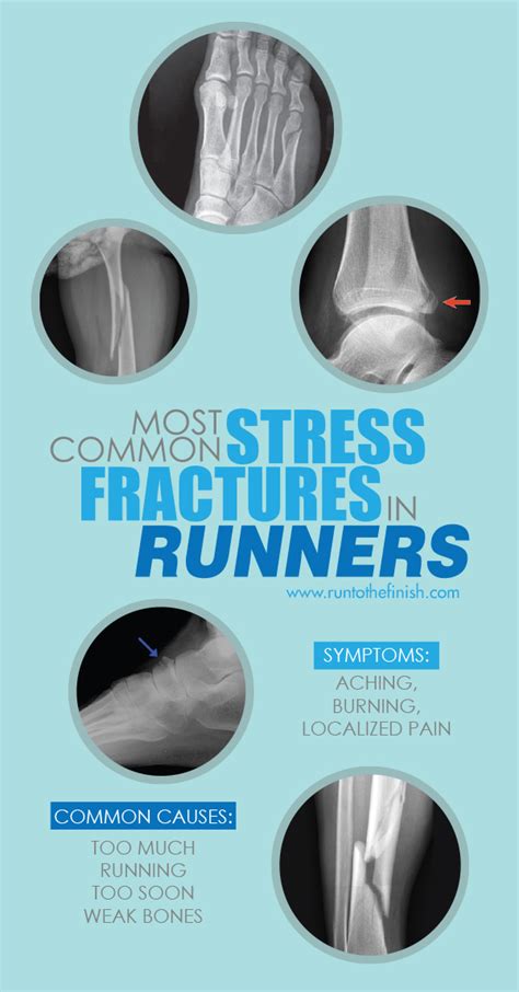 Running Stress Fracture Shin Symptoms