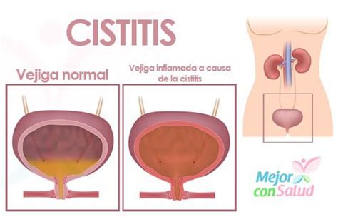 Enfermeras Posturno Cistitis