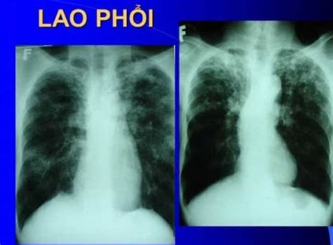 Cách chẩn đoán và điều trị bệnh án lao phổi ho ra máu hiệu quả