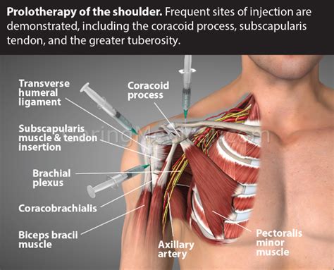 How To Repair A Rotator Cuff Tear Tomorrowfall9