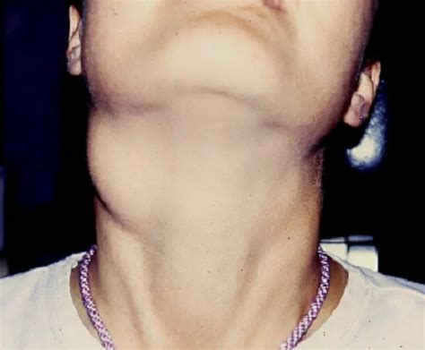 Quiste cervical Definición y manejo
