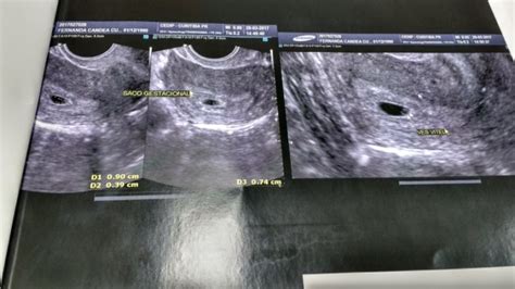 Ultrassom 4 Semanas Acabei De Descobrir BabyCenter