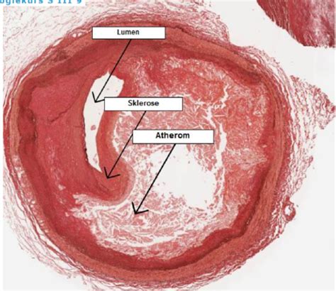 Pathologie Von KHK Und Myokardinfarkt Flashcards Quizlet