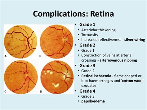 Stages Of Hypertensive Retinopathy