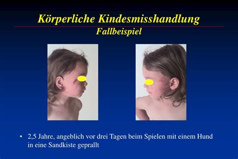 Ppt Kindeswohlgef Hrdung Aus Sicht Des Kinder Klinikarztes