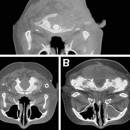 Postoperative Computed Tomography Scans Bone Window Illustrating The