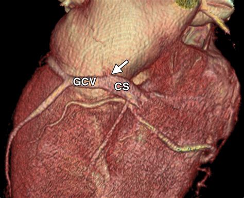 Imaging Of The Coronary Sinus Normal Anatomy And Congenital