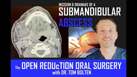 Neck Abscess Drainage How To Drain A Submandibular Dental Infection
