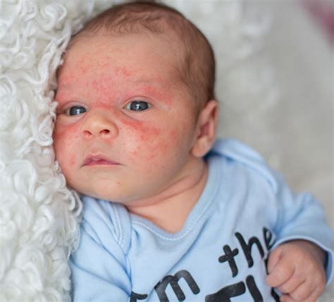 Dermatită atopică la nou născut simptome GALERIE FOTO