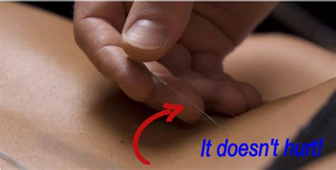 Why You Should Give Acupuncture A Try