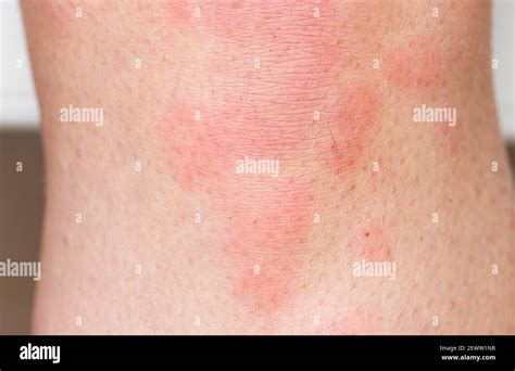 Eruzione Cutanea Immagini E Fotos Stock Alamy