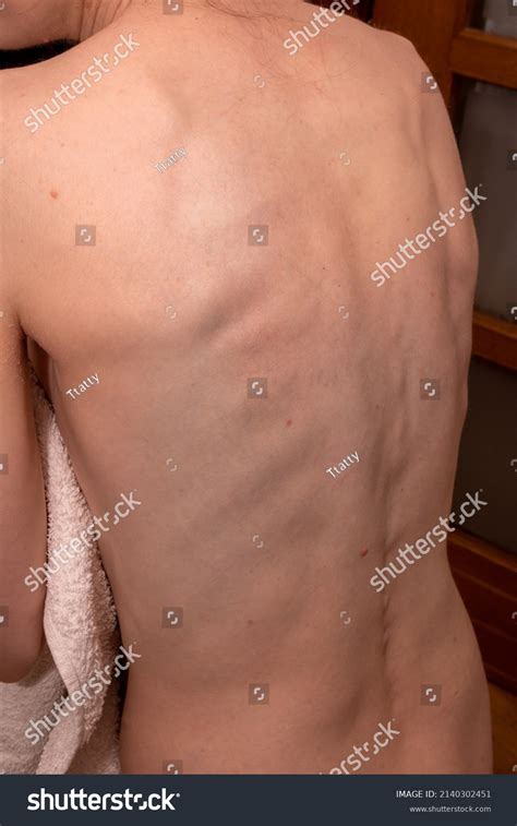 Emancipated Anorexic Woman Bones Showing On Stock Photo
