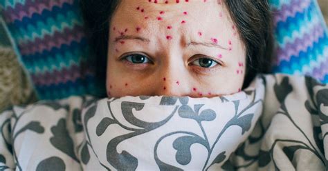 Can You Get Shingles If You Never Had Chickenpox