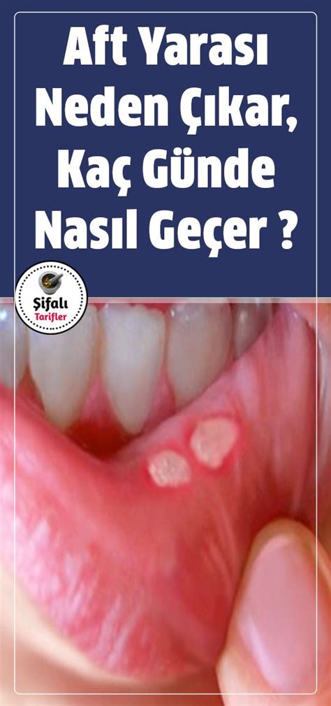 AFT YARASI NEDEN ÇIKAR VE NASIL GEÇER Ağız içerisinde ufak yada büyük