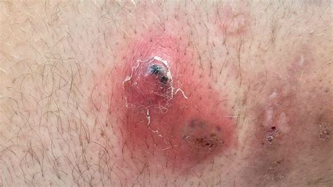 Pubic Ingrown Hair Cyst