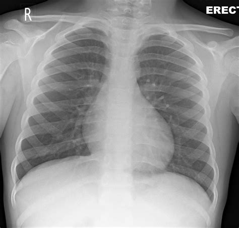 Normal Chest X Ray Images