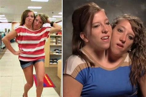 Conjoined Twin Abby An Extraordinary Journey Of Courage And Resilience