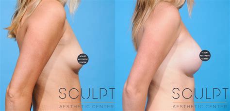 Before After Photo Gallery Sculpt Aesthetic Center
