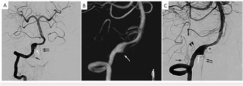 Preoperative Angiographic Images A Right Vertebral Angiogram