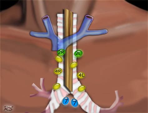 The Radiology Assistant Mediastinal Lymph Node Map