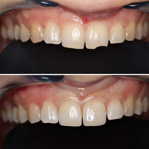 Restauração estética colocação de resina composta direta You