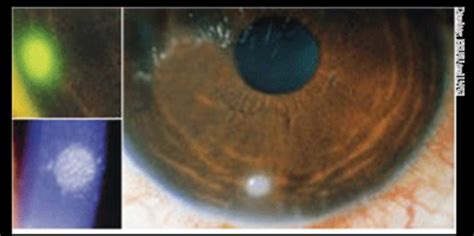 Contact Lens Complications Flashcards Quizlet