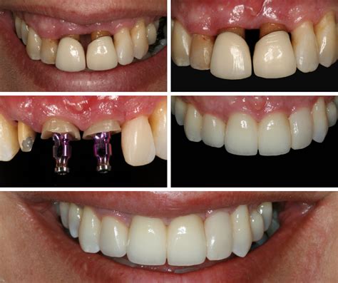 OrisClinic Implantes dentários as diferentes fases do tratamento