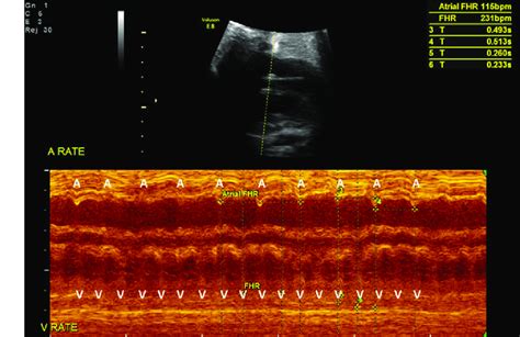 Fetal M Mode Echocardiogram Of Atrial And Ventricular Free Wall