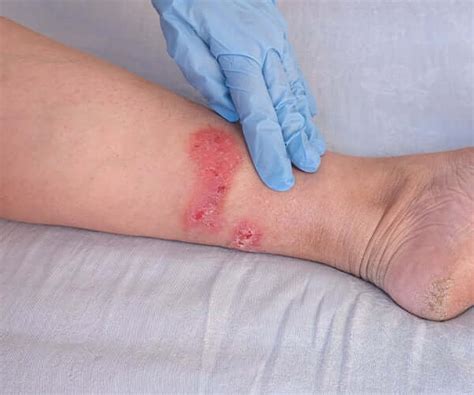 Necrotizing Soft Tissue Infections DFW Wound Care Center Wound Care