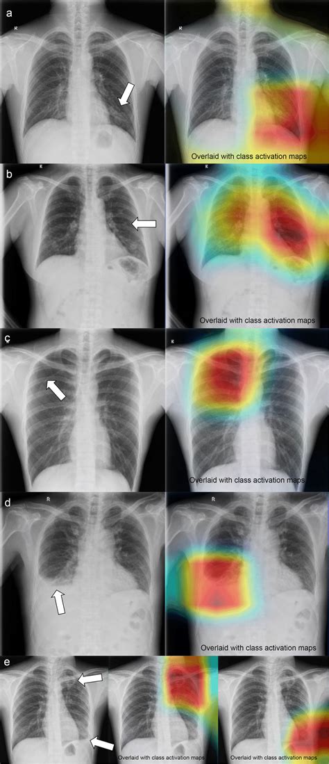 Representative Chest Radiographs Overlaid With Class Activation Maps