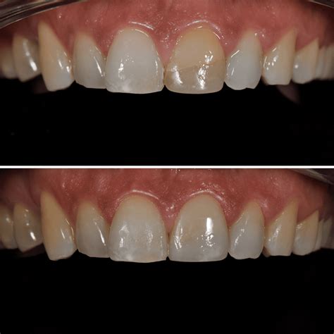 Restauração Direta em Resina Composta You Clínica Dentária