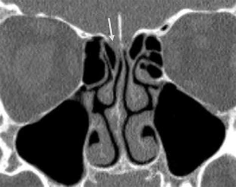 Imaging Of Cerebrospinal Fluid Rhinorrhea And Otorrhea Radiologic Clinics