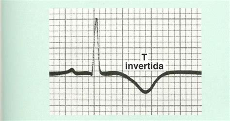 Dr Rafael Soto Electrocardiografía Cardiología clínica Infarto
