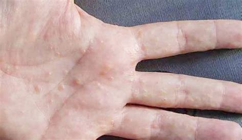 Nổi Mụn Nước Ngứa Ở Chân Tay Là Bệnh Gì Làm Sao Hết