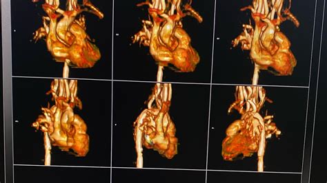 MRI Cardiac TOF Time Of Flight Magnetic Resonance Angiography TOF