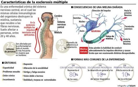 Novedosos Medicamentos Para Tratar La Esclerosis M Ltiple Noticias Y