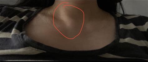 Lump On Neck Near Collar Bone