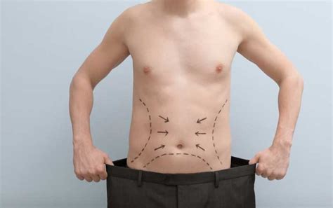 Cuál es la diferencia entre abdominoplastia y liposucción