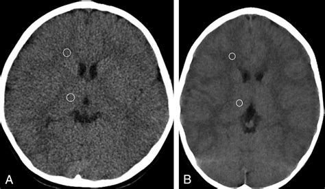 comparison of iterative model reconstruction versus filtered back projection in pediatric