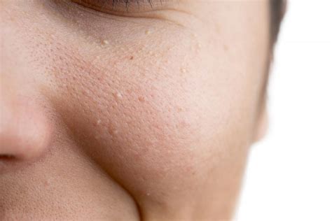 Unmasking Small Bumps On The Face Understanding And Treating Non Acne